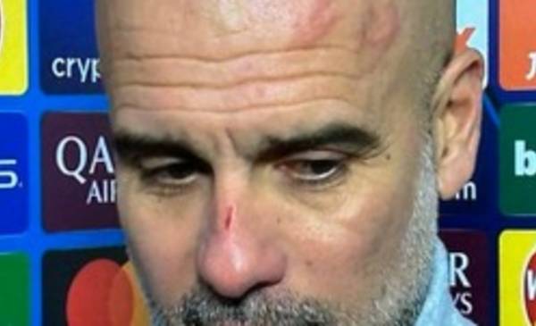 Pep Guardiola apareció con arañazos y sorprendió con su explicación ...